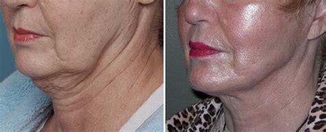 Older Female Facelift Result Oblique View Dr Barry Eppley Indianapolis Explore Plastic Surgery