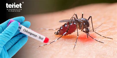 What Is Chikungunya Fever And How Should I Diagnose It