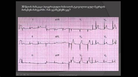 ეკგ ნაადრევი რეპოლარიზაციის სინდრომი St სეგმენტის მაღალი გამოსვლის სინდრომი Youtube