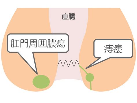 肛門周囲膿瘍痔瘻について高田馬場駅前メディカルクリニック新宿区の消化器内視鏡内科外科肛門科