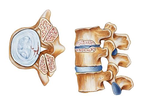 Spinal Stenosis Causes Symptoms And Treatment