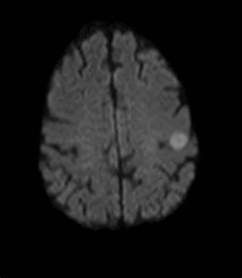 Mri Simulation For Brain Metastases Treatment Philips Mr Body Map