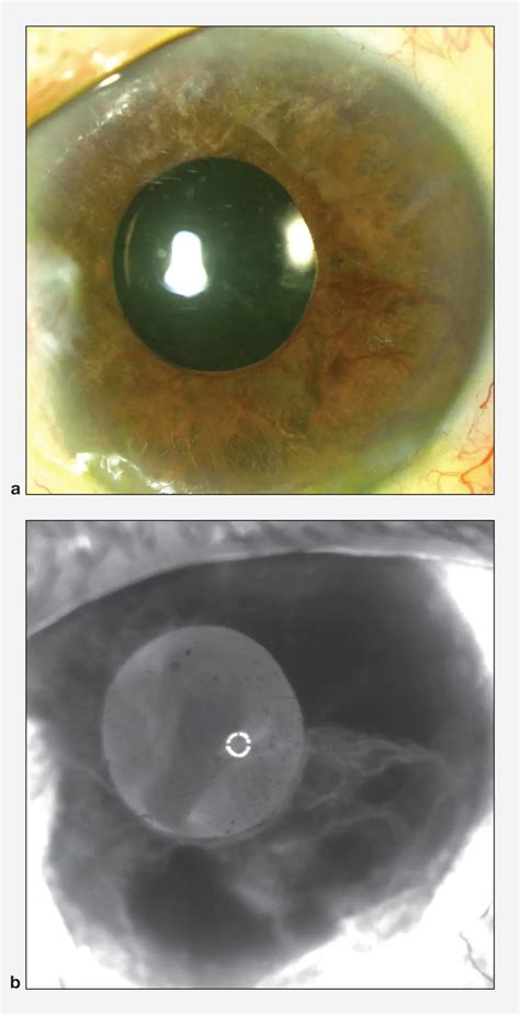 Iris Neovascularization American Academy Of Ophthalmology