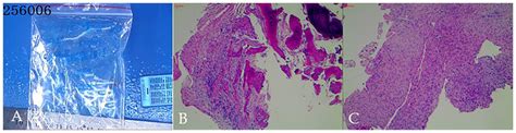 Pathology Examination For Left Femoral Percutaneous Biopsy A Left