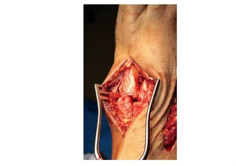 Lisfranc Fracture Dislocation Ppt