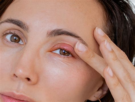 Chalazion Eyelid Cyst Removal Surgery Birmingham Book Now