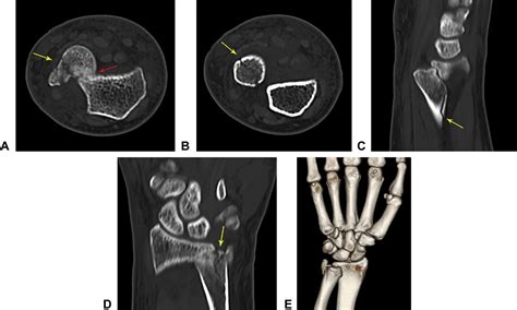 Figure 2 From Locked Volar Distal Radioulnar Joint Dislocation