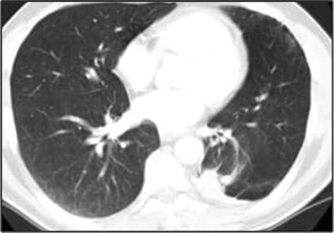 Rounded Lung Collapse Pacs