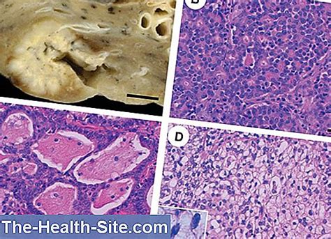 Nsclc Genesis Species Therapy 💊 Scientific Practical Medical Journal