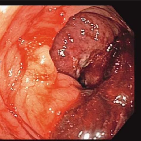 Colonoscopy View Of The Tumor In The Hepatic Flexure Download Scientific Diagram