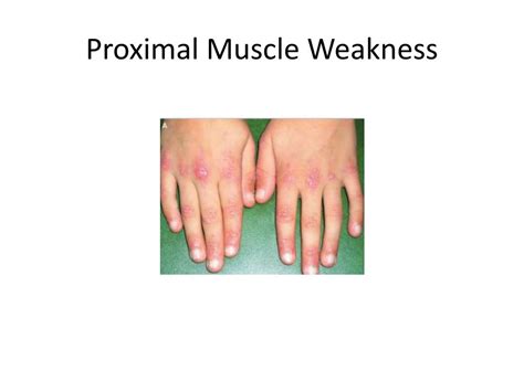Ppt Proximal Muscle Weakness Powerpoint Presentation Free Download