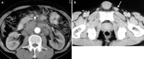 Congenital And Acquired Nonneoplastic Disorders Of The Spermatic Cord