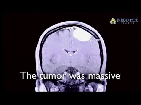 Right Parietal Convexity