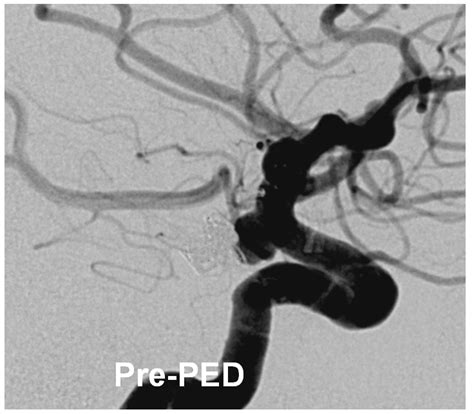 Pipeline Device Aneurysm Selection Neuroangio Org