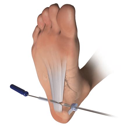 Arthrex Endoscopic Plantar Fascia