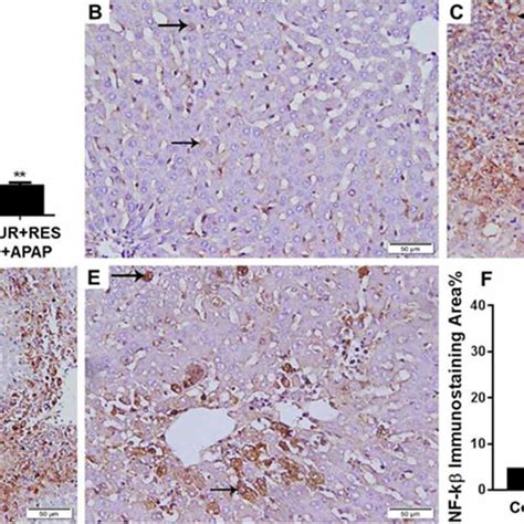 Paracetamol Apap Induced Hepatic Tnf α And Nf Kb Expression Is