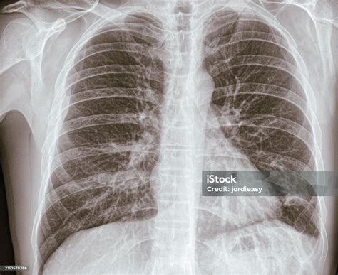 X Ray Radiograph Right Shoulder With Many Broken Ribs And Shoulder