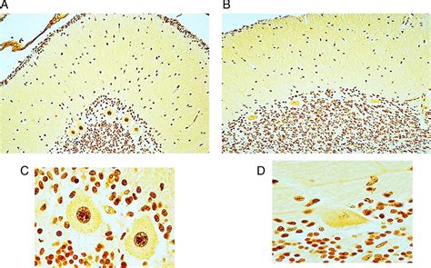 Decreased Argyrophilic Nucleolar Organiser Region Agnor Expression In