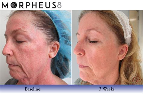 Morpheus8 Dr Heather Roberts