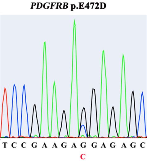 Presence Of Pdgfrb E472d Mutation In Tumor Tissue Identified By Sanger
