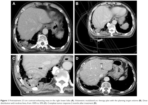 Primary Lung Sarcoma Treated With Stereotactic Ablative Radiotherapy Ott