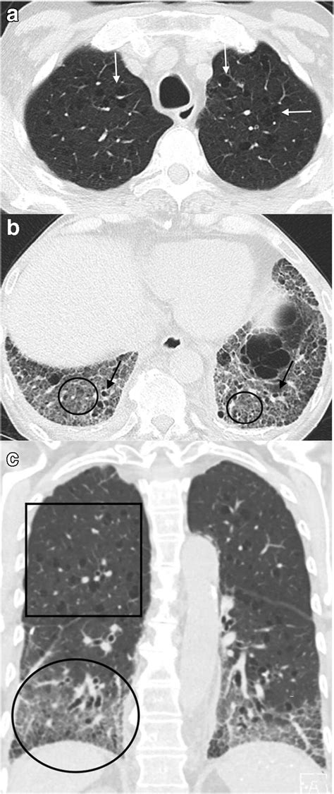 Combined Pulmonary Fibrosis And Emphysema Cpfe A Non Contrast Hrct