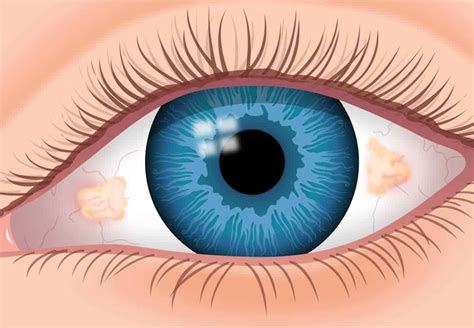 What Does White Spot On Eye Mean