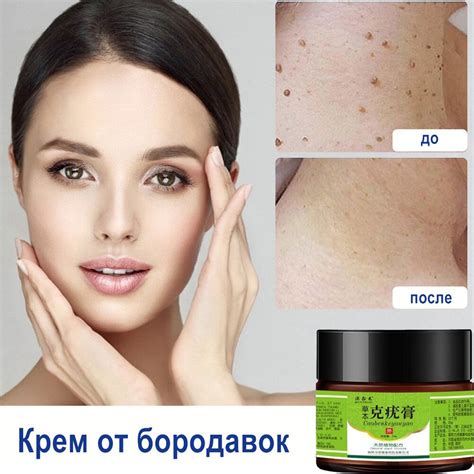 Крем для удаления бородавок и родинок 20g от папиллом и бородавок на