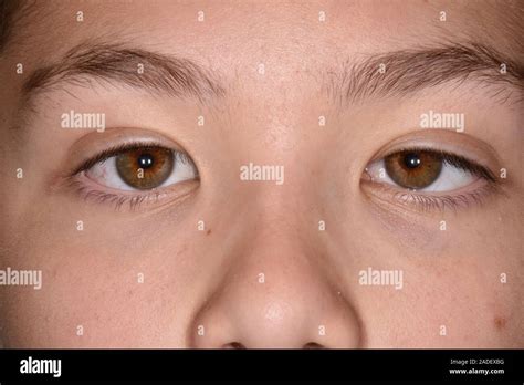 MODEL RELEASED Strabismus Close Up Of The Left Eye Of A Year Old Boy With A Form Of