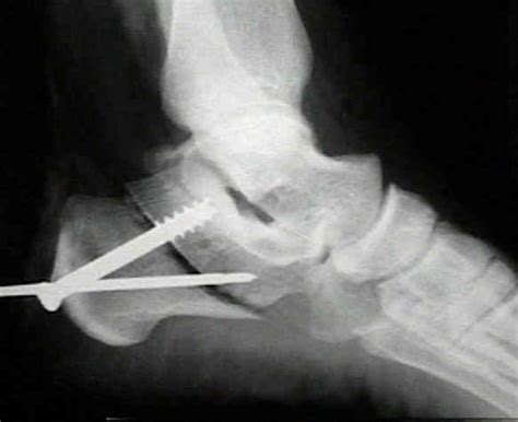 Medial Calcaneal Sliding Osteotomy Wheeless Textbook Of Orthopaedics