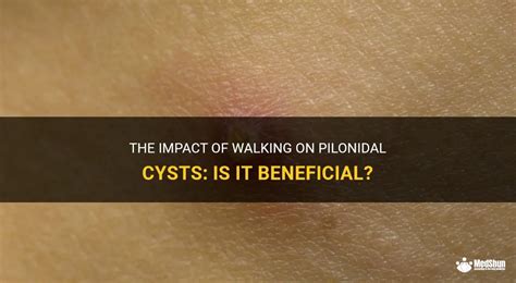The Impact Of Walking On Pilonidal Cysts Is It Beneficial Medshun