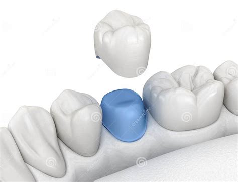 Porcelain Crown Placement Over Premolar Tooth Medically Accurate 3d