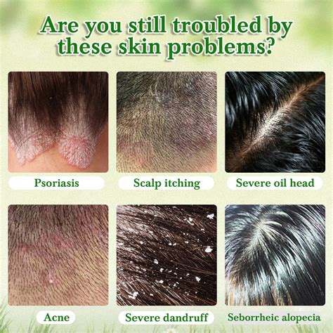 Seborrheic Dermatitis Vs Dandruff Ubicaciondepersonascdmxgobmx
