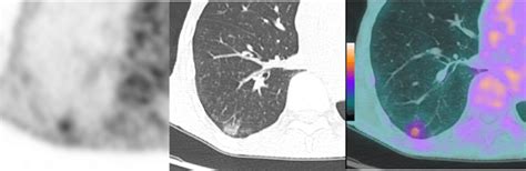 Patient Hospitalisé Pour Endocardite à Enterococcus Faecalis Sur Download Scientific Diagram