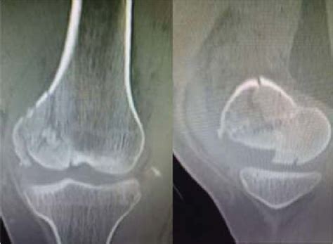 Computed Tomography Scan Coronal And Sagittal Cuts Download