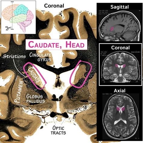 Neuroanatomy Glossary Caudate Nucleus Head Ditki Medical And Biological Sciences