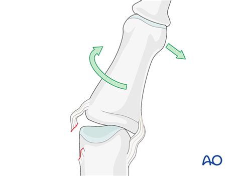 Dislocation And Fracture Dislocation Of The Proximal Interphalangeal Joint