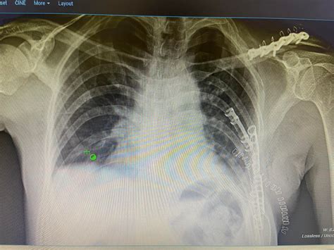 Дорноговийн эмч нар өвдөг түнхний үе солиулах хагалгааг нутагшуулж байна