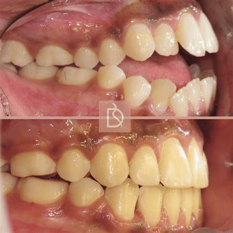 Correcting Bite Function And Jaw Misalignment With Invisalign DOTB