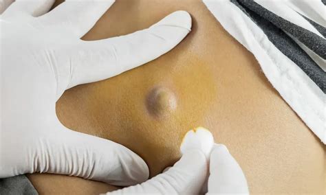 What To Do When A Cyst Wont Go Away Dermatologists Located In