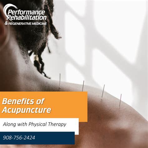 Benefits Of Acupuncture Along With Physical Therapy In Nj Performance