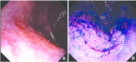 Heterotopic Gastric Mucosa In The Low Perineal Rectum A Slightly