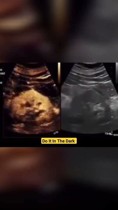 Renal Oncocytoma Radiology Ultrasonography Health Ultrasound