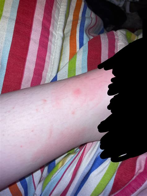 Tiny Black Bugs That Jump Theyve Been All Over Me Rbugbites