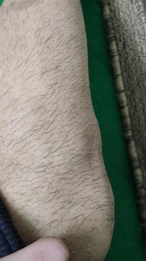 22m Can One Get Osd By A Bad Fall If Not What Is This Called Rmedical