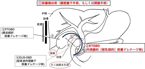 胆道（胆のう、胆管）疾患診療｜社会医療法人三栄会 ツカザキ病院