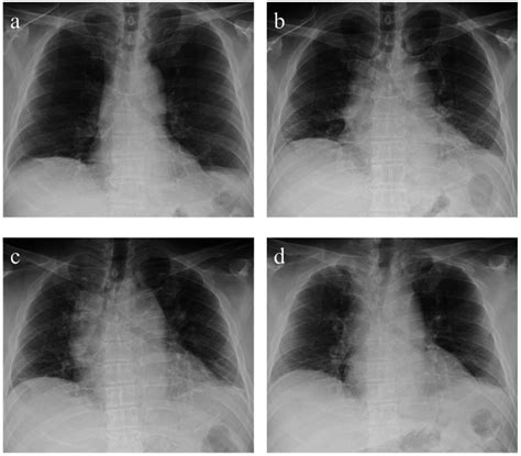 Bilateral Phrenic Nerve Palsy Associated With Neuralgic Amyotrophy Pmc