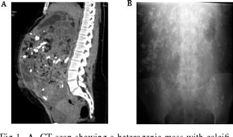 Figure 1 From Giant Mature Ovarian Cystic Teratoma Including More Than