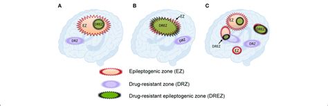 Hypothesized Relationships Between The Drug Resistant Epileptogenic Download Scientific