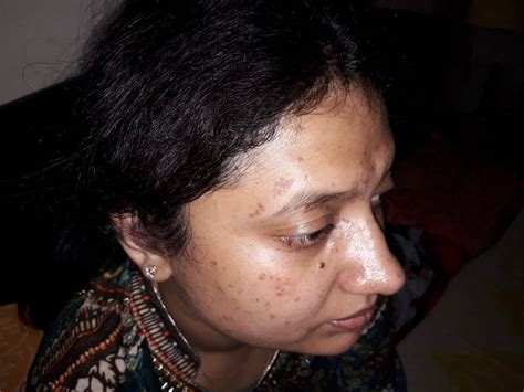 Flat Warts For 8 9 Years Cured By Homeopathy And Medicine Transmission